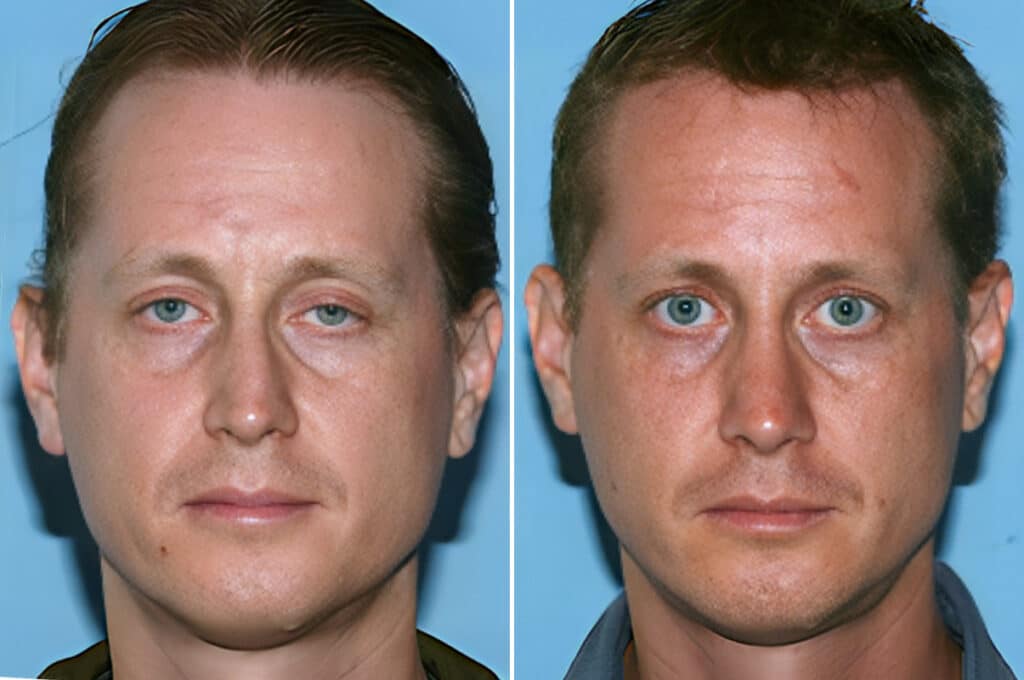 Expert Rhinoplasty for Refining Broad Nose Bridges