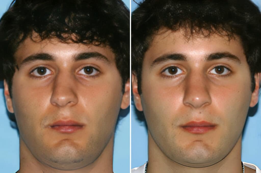 Expert Rhinoplasty for Refining Broad Nose Bridges