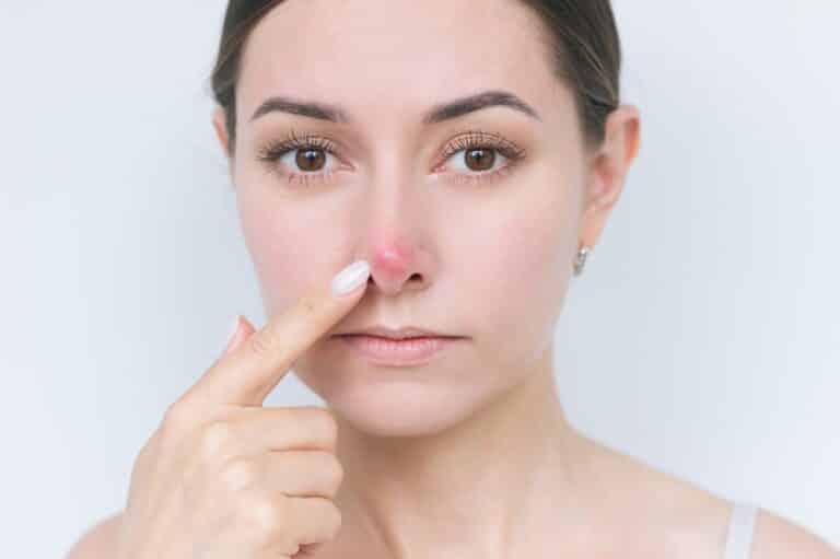 Guide to Handling Post-Rhinoplasty Tip Discoloration & Care